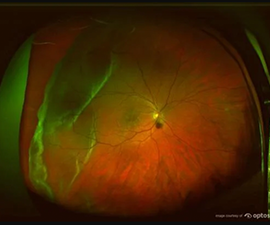 Retinal Tear Optomap Walker Campbell