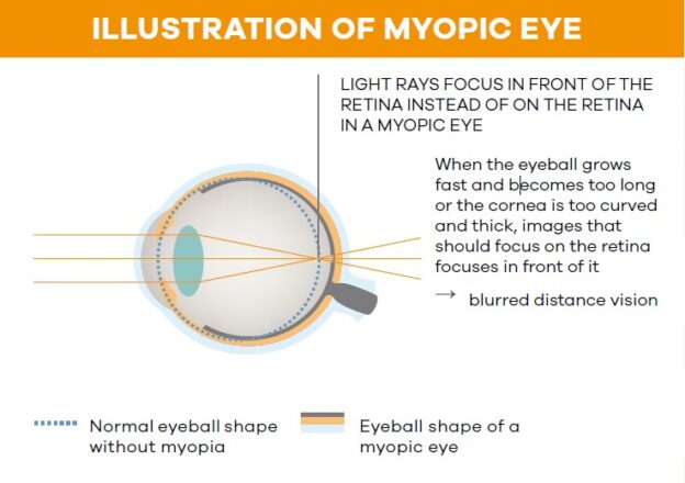 Myopia Management - Walker & Campbell
