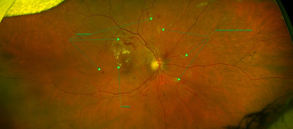 Critical eye conditions found using Optomap - Walker & Campbell