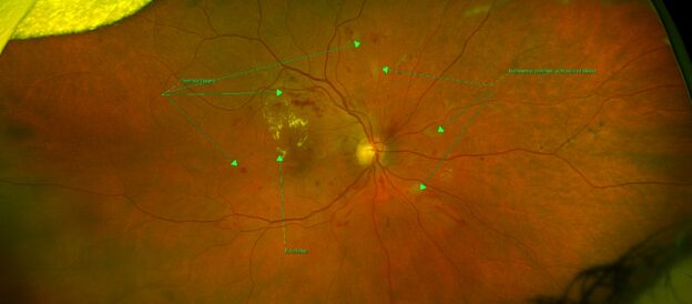 Critical eye conditions found using Optomap - Walker & Campbell