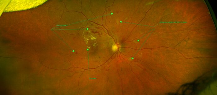 Critical eye conditions found using Optomap - Walker & Campbell