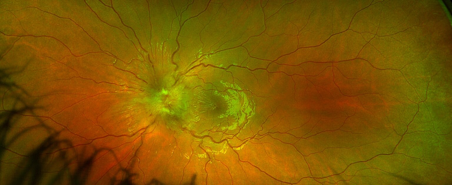 Critical eye conditions found using Optomap - Walker & Campbell