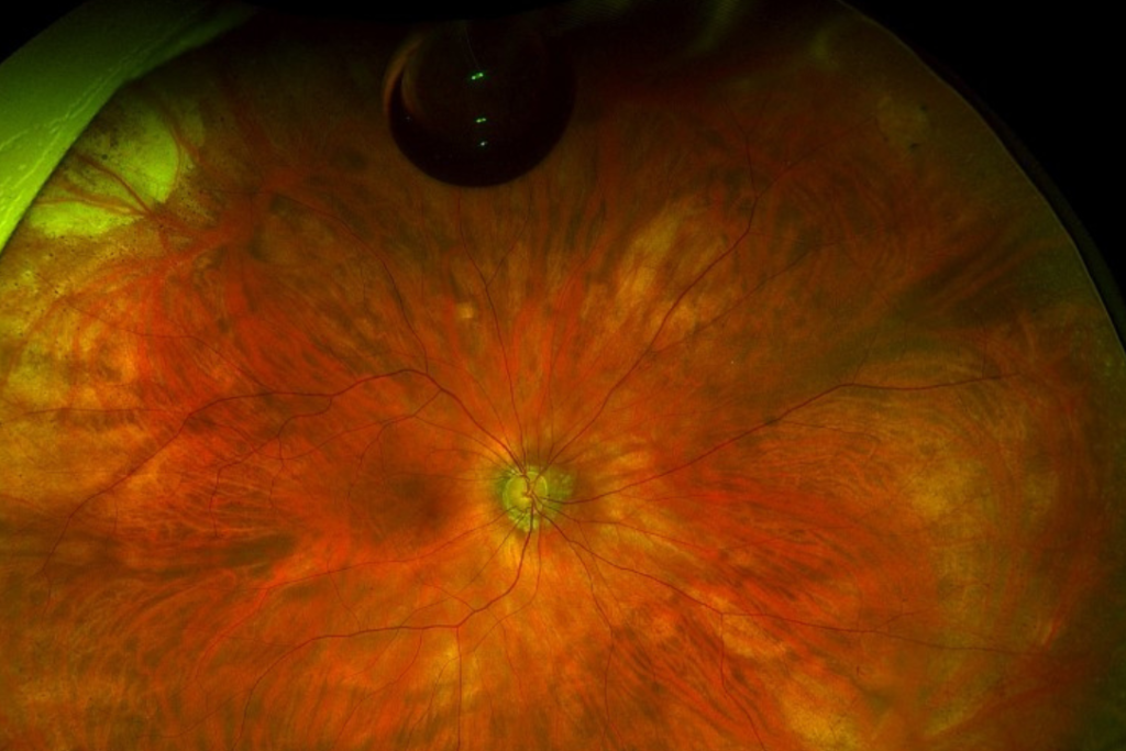Critical eye conditions found using Optomap - Walker & Campbell