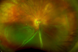 Critical eye conditions found using Optomap - Walker & Campbell