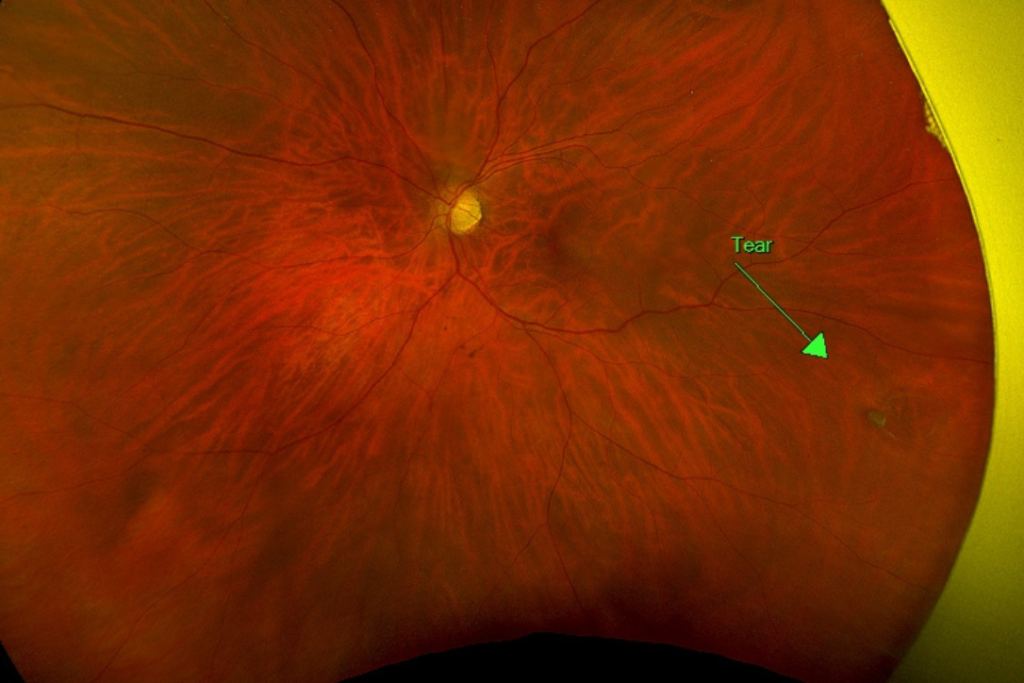 Critical eye conditions found using Optomap - Walker & Campbell