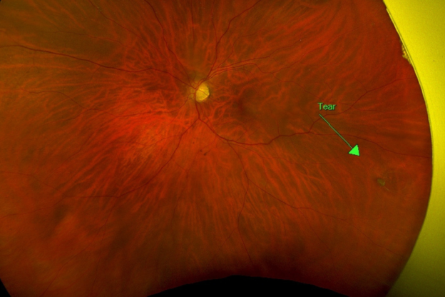 Critical eye conditions found using Optomap - Walker & Campbell