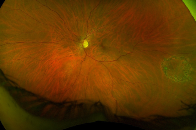 Critical eye conditions found using Optomap - Walker & Campbell
